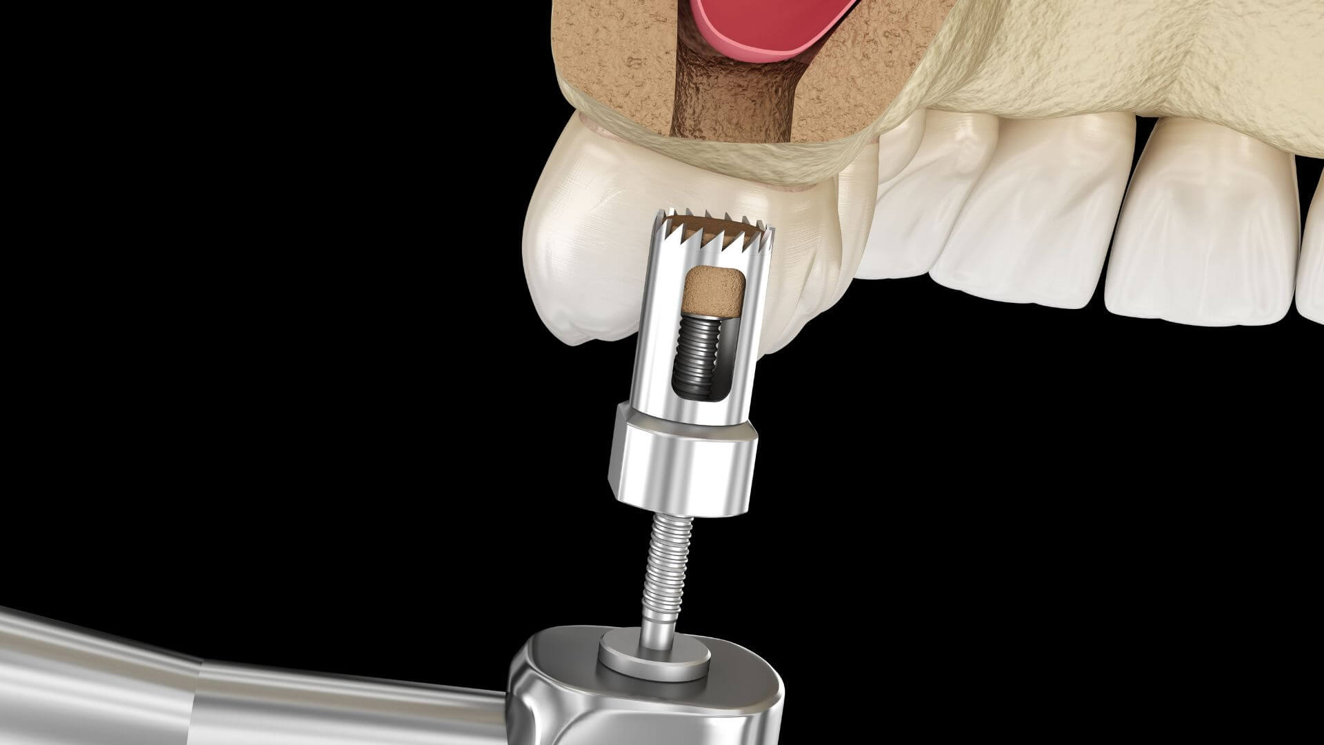 Sinus Lift: Ce este, Reactii, Pret si Tipuri - LLL Dental