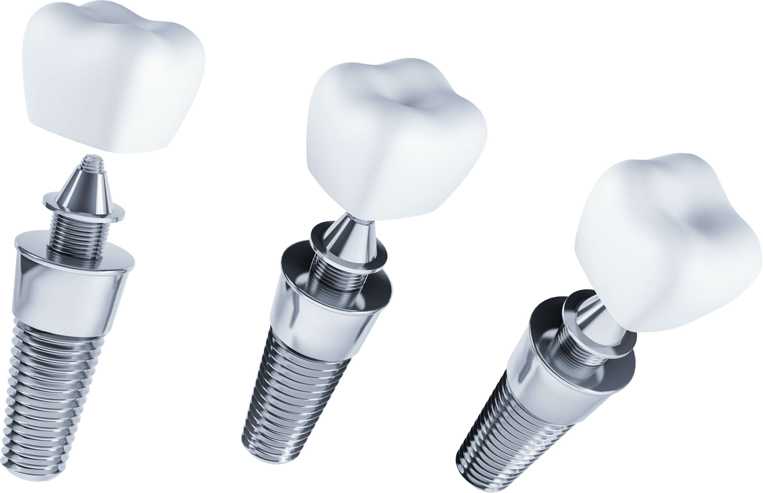 Tipuri de Implanturi Dentare: Cum faci Alegerea Corectă? - LLL Dental